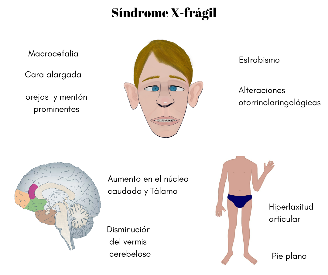 S ndrome X Fr gil Autismo Ciudad De M xico S ndrome X Fr gil Autismo Ciudad De M xico